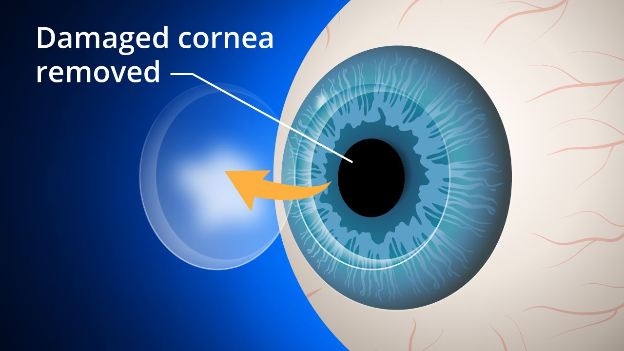 Precision Vision: Harnessing Corneal Topography for Tailored Contact ...