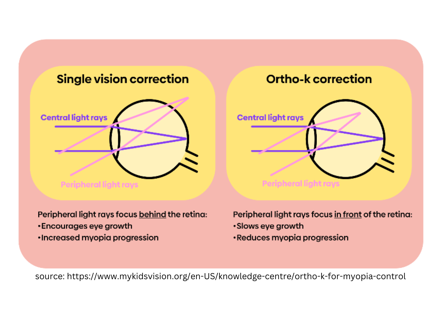 Ortho-K FAQ | Vision Space